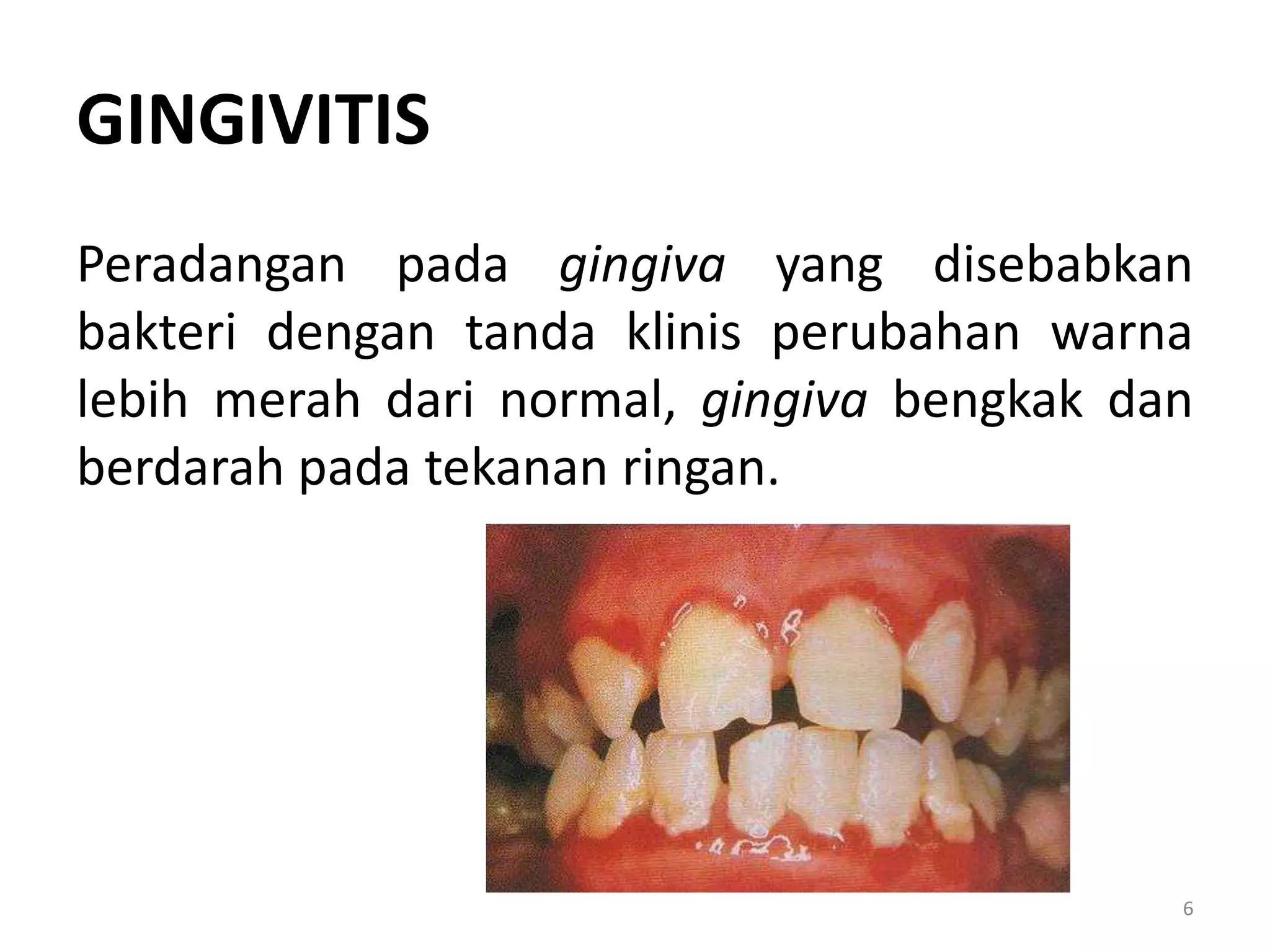 Gingivitis | PPTX