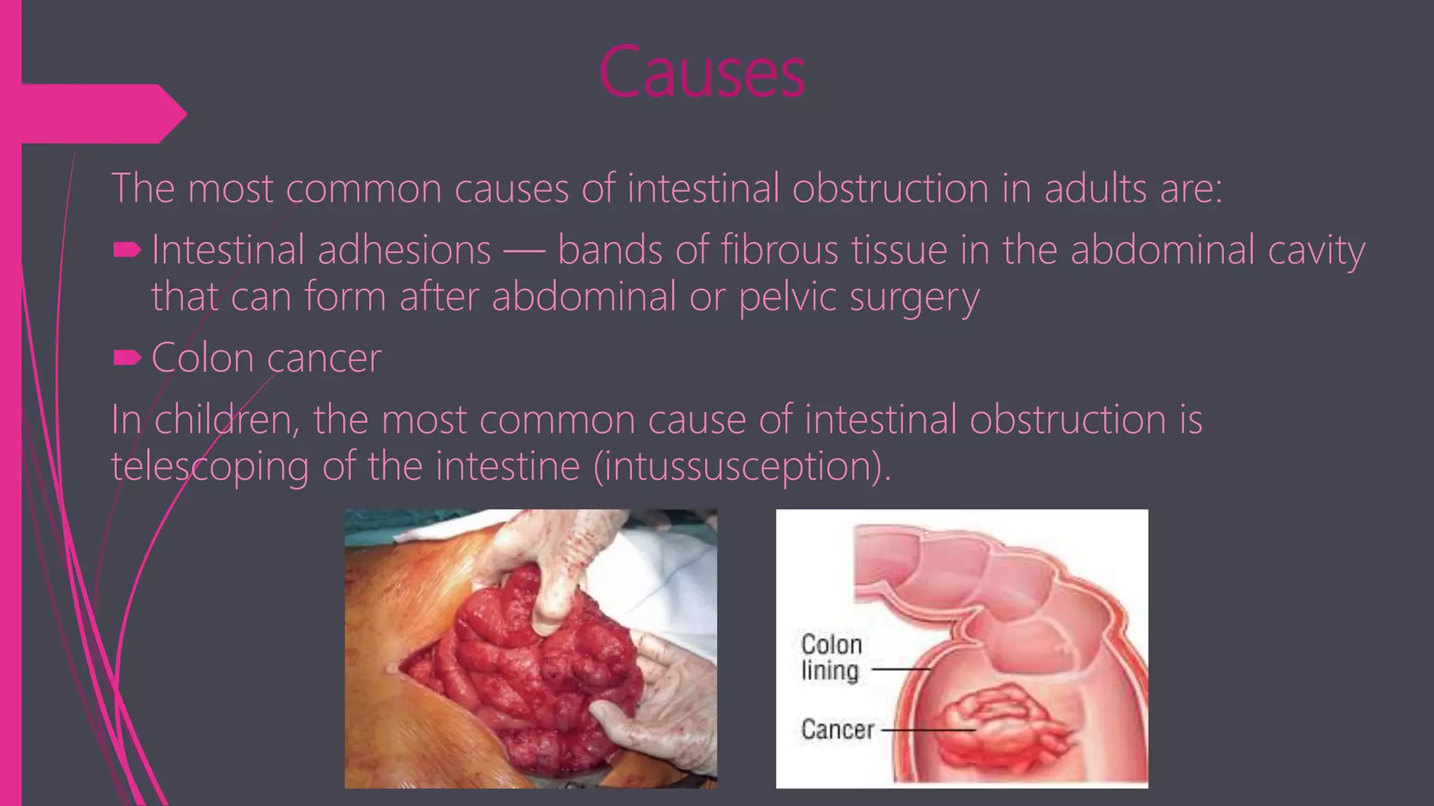 Gastrointestinal obstruction | PPTX | Digestive Disorders | Diseases ...