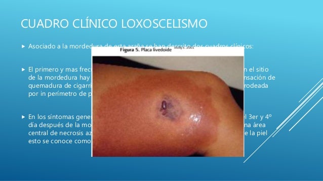 Picaduras de Araña Parda Violinista y Viuda Negra