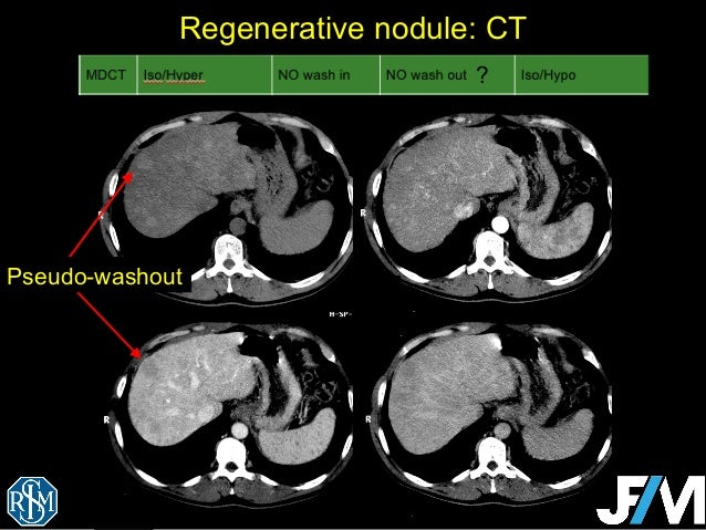 Giovanni Morana, diagnostic imaging of small hcc in liver cirrhosis,