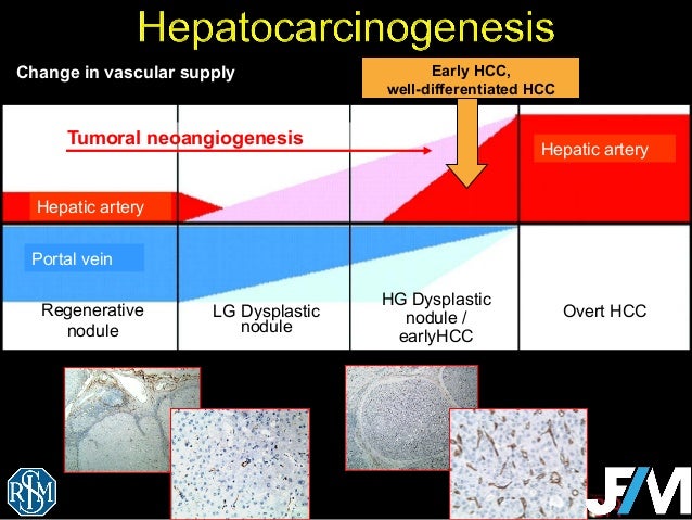 Giovanni Morana, diagnostic imaging of small hcc in liver cirrhosis,