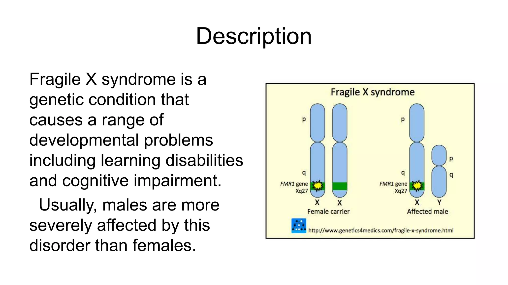 Fragile x syndrome | PPTX