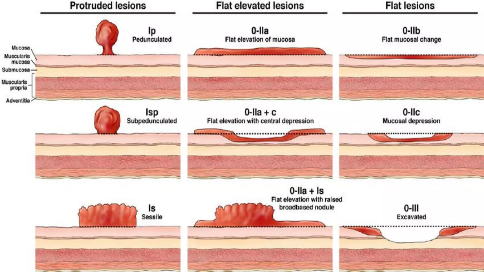 Gi Polyps Pdf