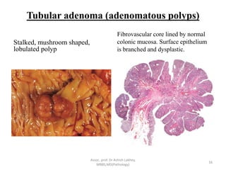 GI polyps.pptx