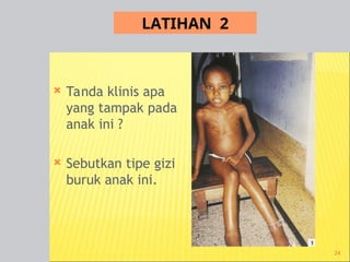 Tanda dan gejala klinis anak yang gizi buruk.ppt