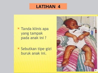 Tanda dan gejala klinis anak yang gizi buruk.ppt