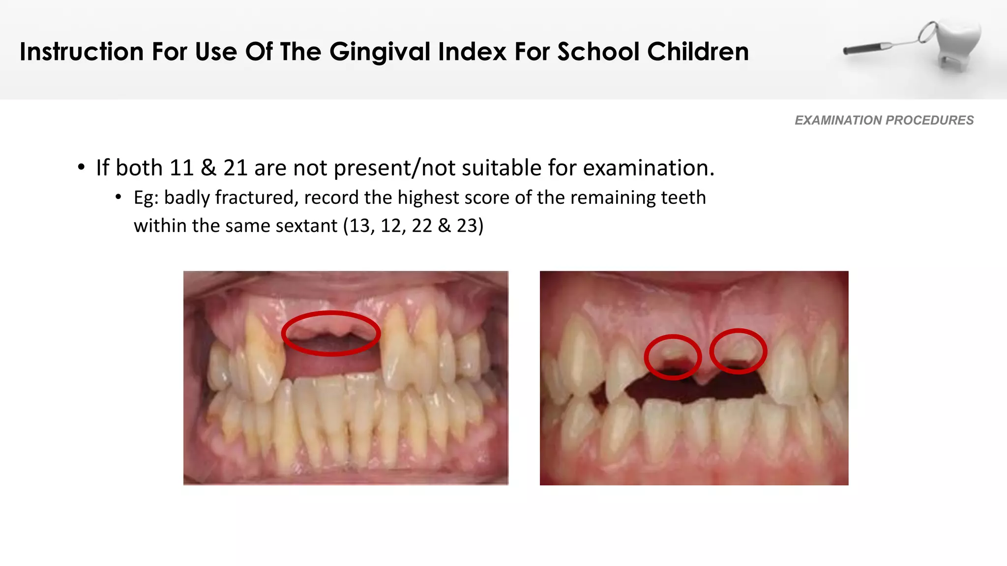 Gingival Index For Schoolchildren | PDF