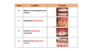 Gingival Index For Schoolchildren | PDF