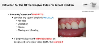 Gingival Index For Schoolchildren | PDF