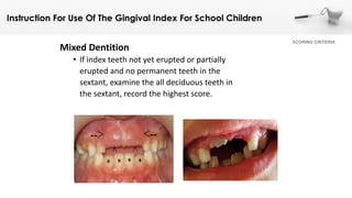 Gingival Index For Schoolchildren | PDF