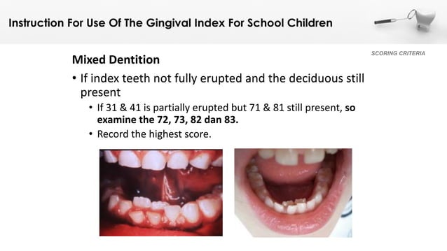 Gingival Index For Schoolchildren | PDF | Dental Health | Diseases and ...