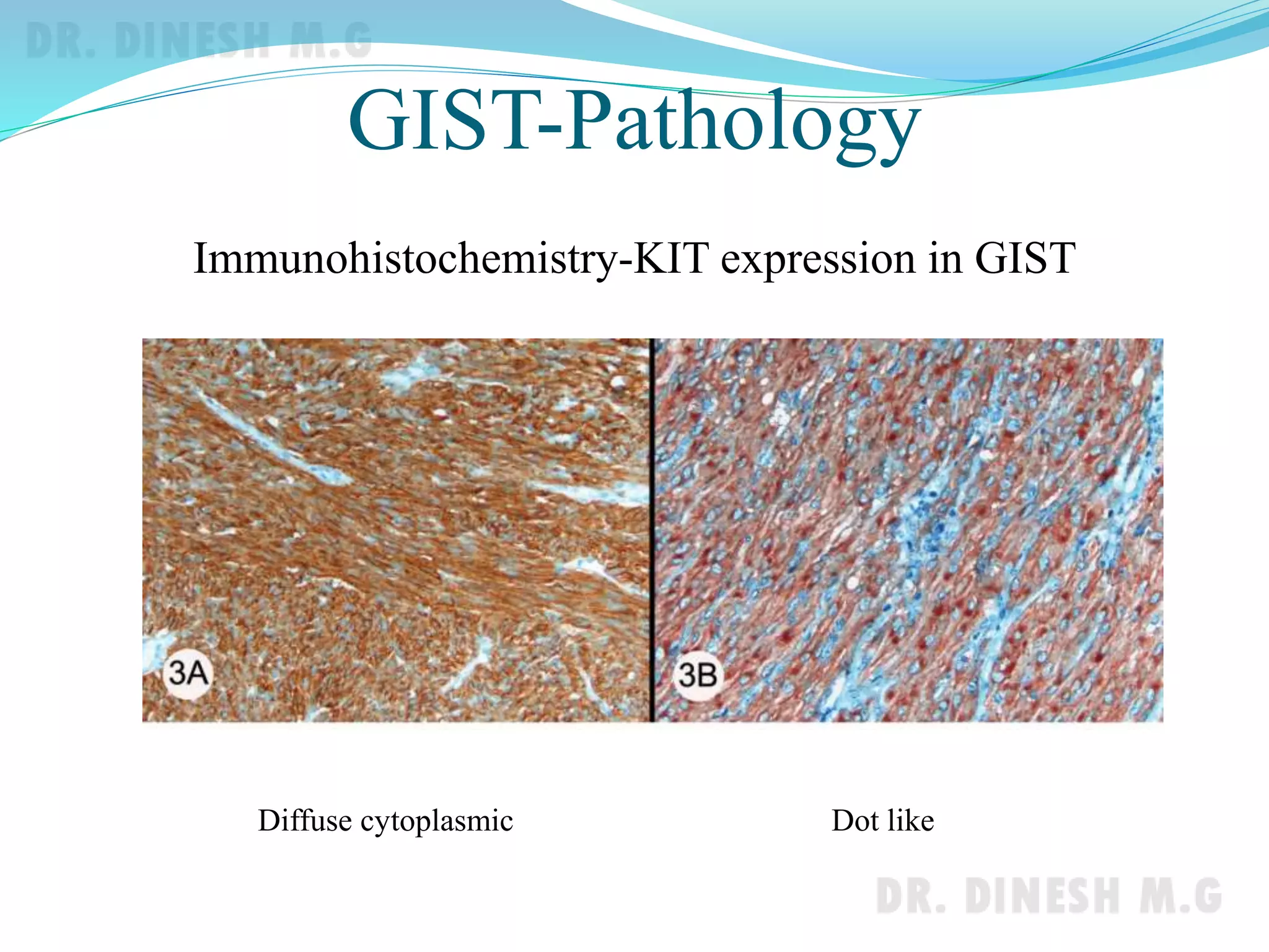GIST | PPTX | Digestive Disorders | Diseases and Conditions