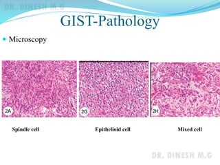 GIST | PPTX | Digestive Disorders | Diseases and Conditions