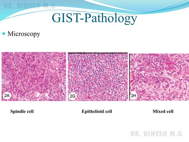 GIST | PPTX | Digestive Disorders | Diseases and Conditions