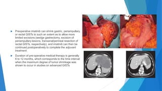 GastroIntestinal Stromal tumors. | PPTX