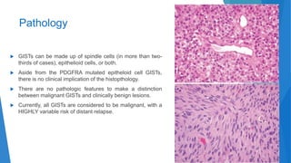 GastroIntestinal Stromal tumors. | PPTX