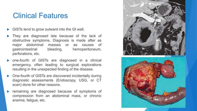 Gastrointestinal Stromal Tumors Pptx