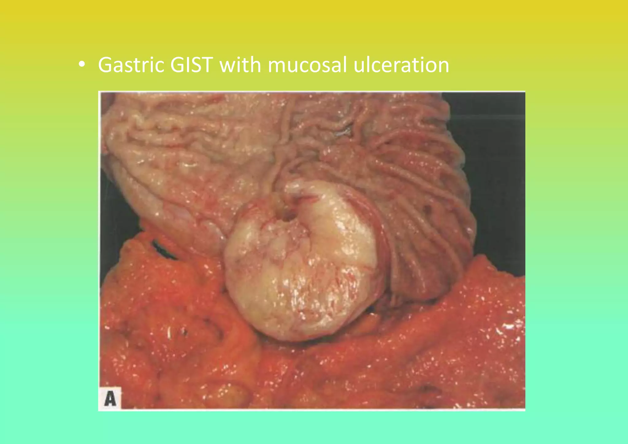 Gastro intestinal stromal tumor(GIST)-PATHOLOGY | PPTX