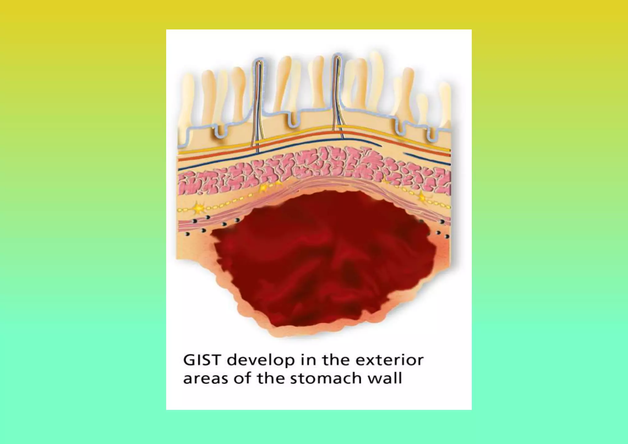 Gastro intestinal stromal tumor(GIST)-PATHOLOGY | PPTX