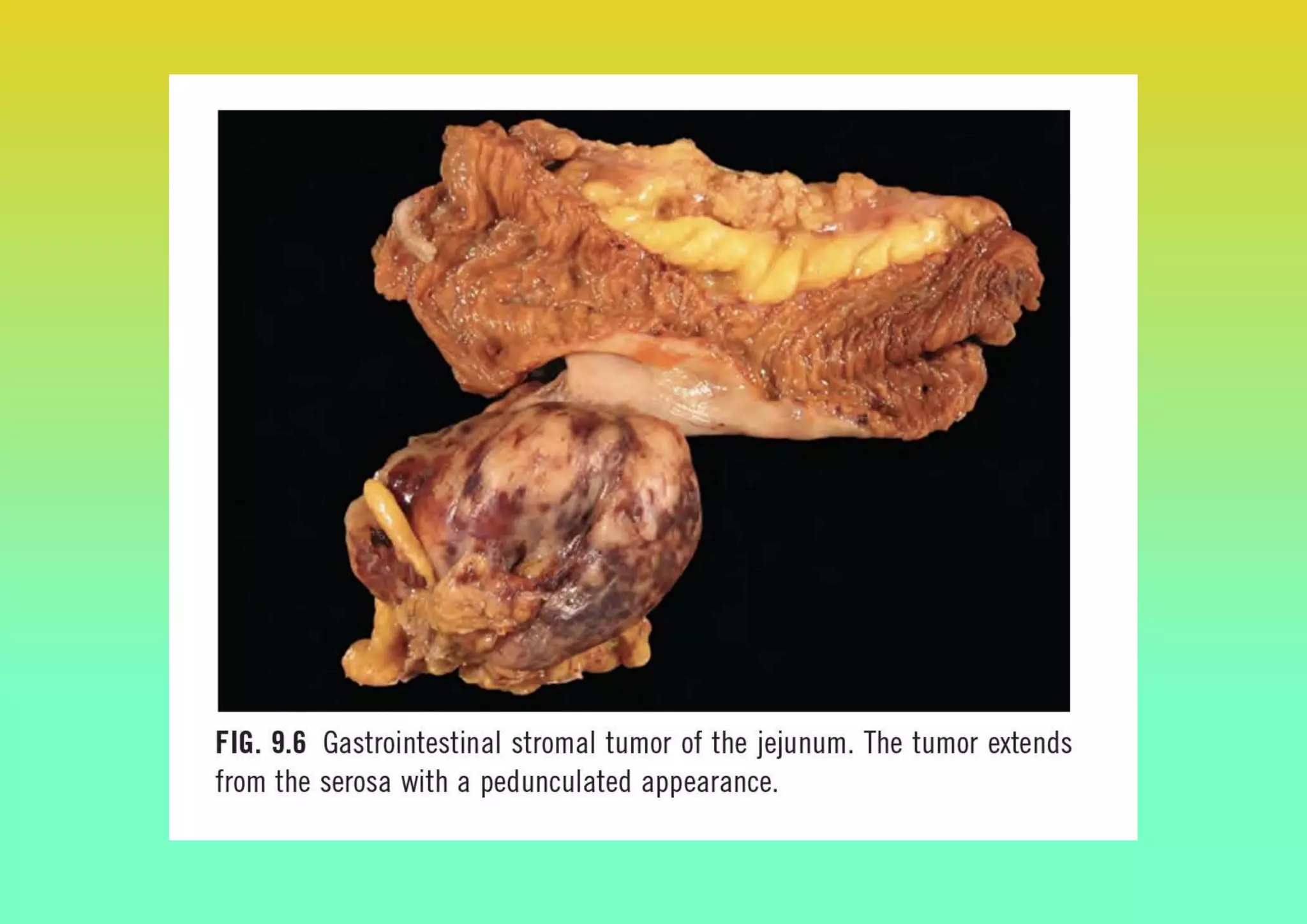 Gastro intestinal stromal tumor(GIST)-PATHOLOGY | PPTX