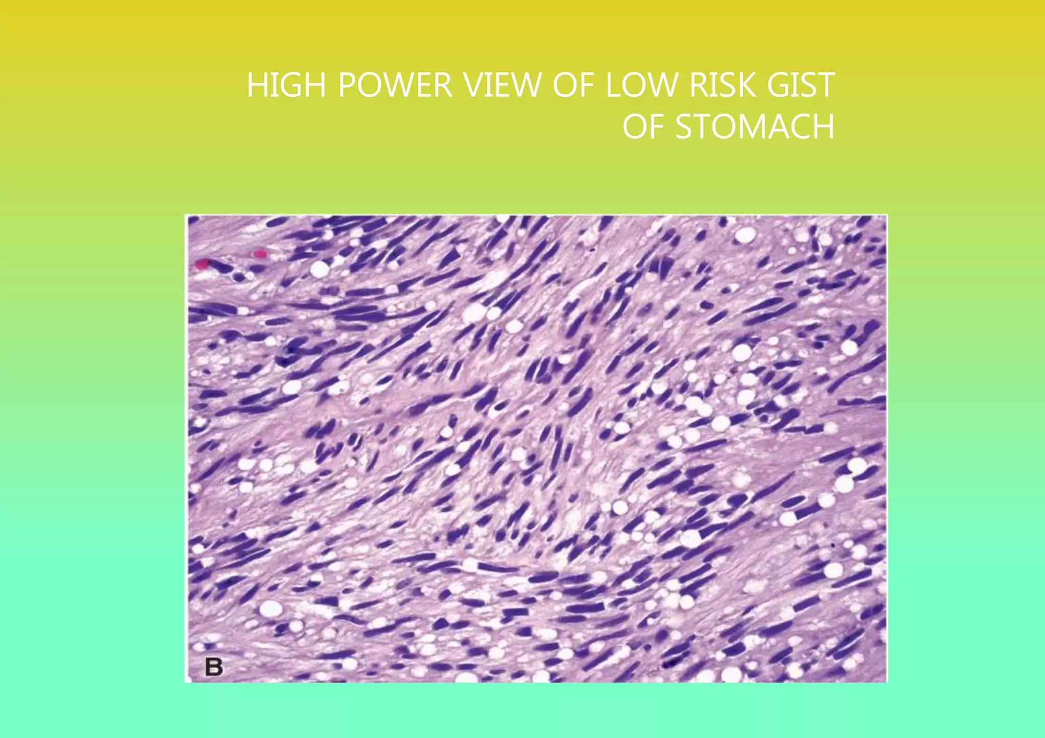 Gastro intestinal stromal tumor(GIST)-PATHOLOGY | PPTX