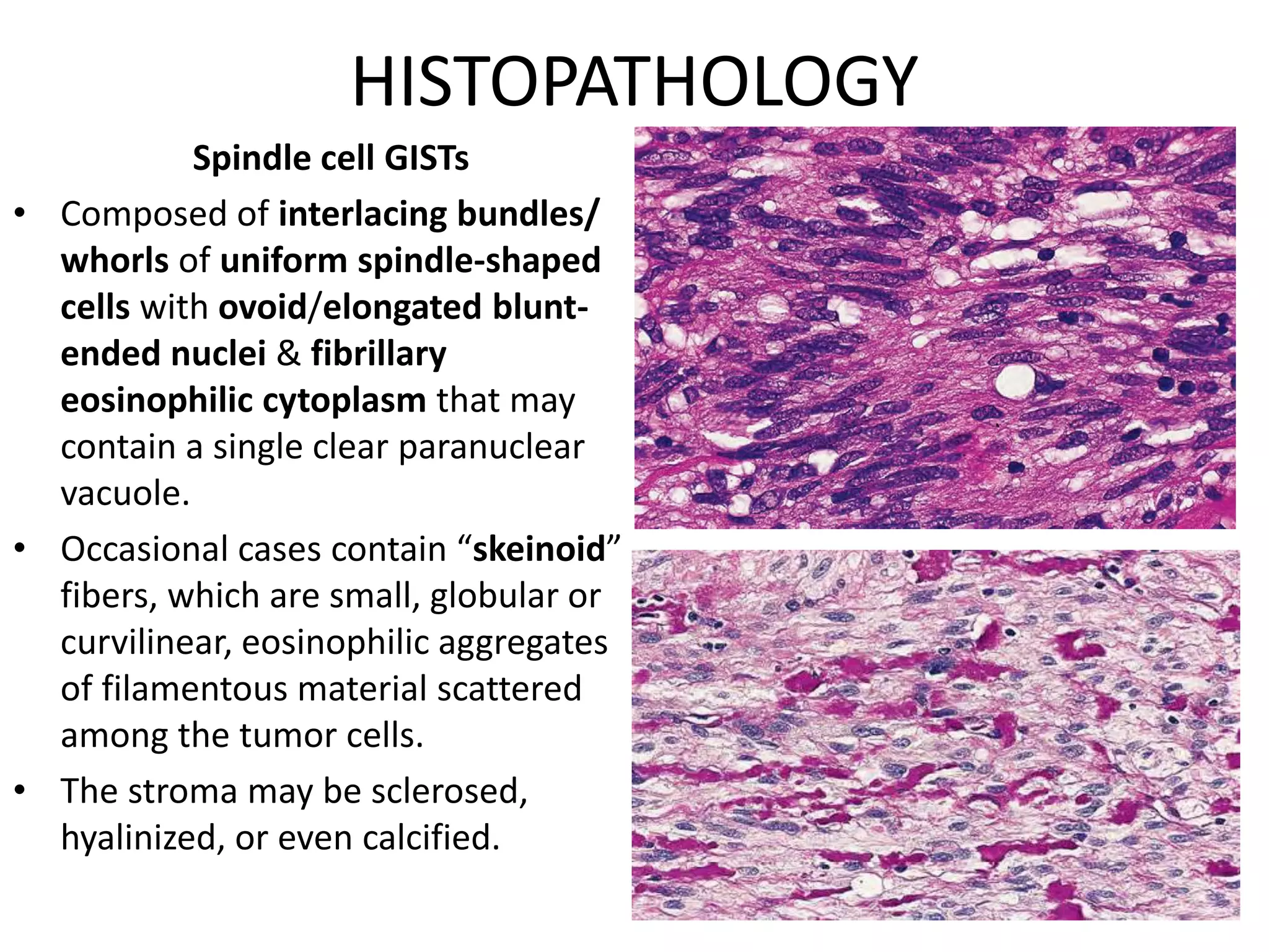 Gastrointestinal Stromal Tumors. | PPTX