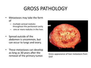 Gastrointestinal Stromal Tumors. | PPTX