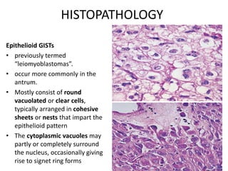 Gastrointestinal Stromal Tumors. | PPTX