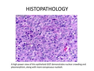Gastrointestinal Stromal Tumors. | PPTX