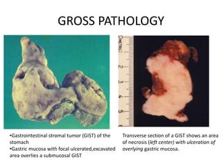 Gastrointestinal Stromal Tumors. | PPTX
