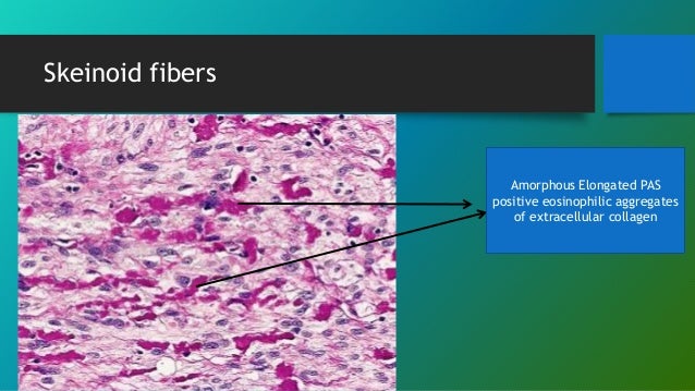 Gastrointerstinal stromal tumor (GIST) recent advances and differenti…