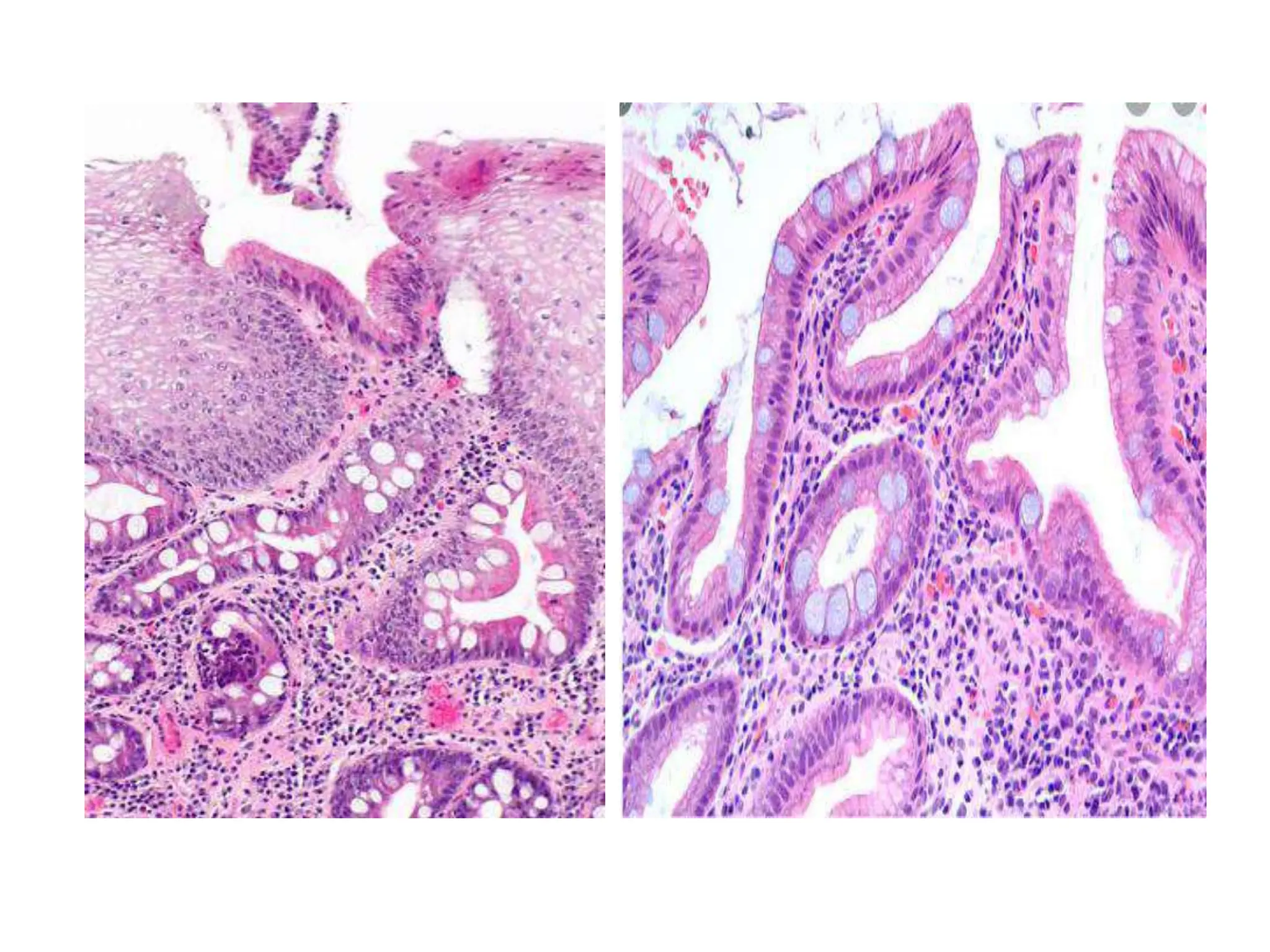Gastrointestinal system ppt GERD Barrett's esophagus Carcinoma ...