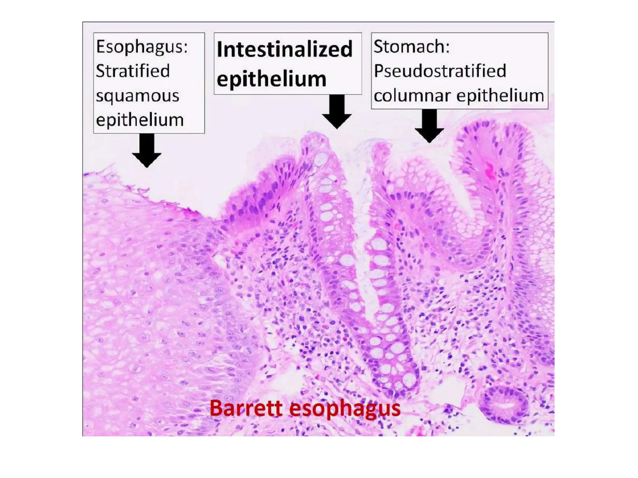 Gastrointestinal system ppt GERD Barrett's esophagus Carcinoma ...