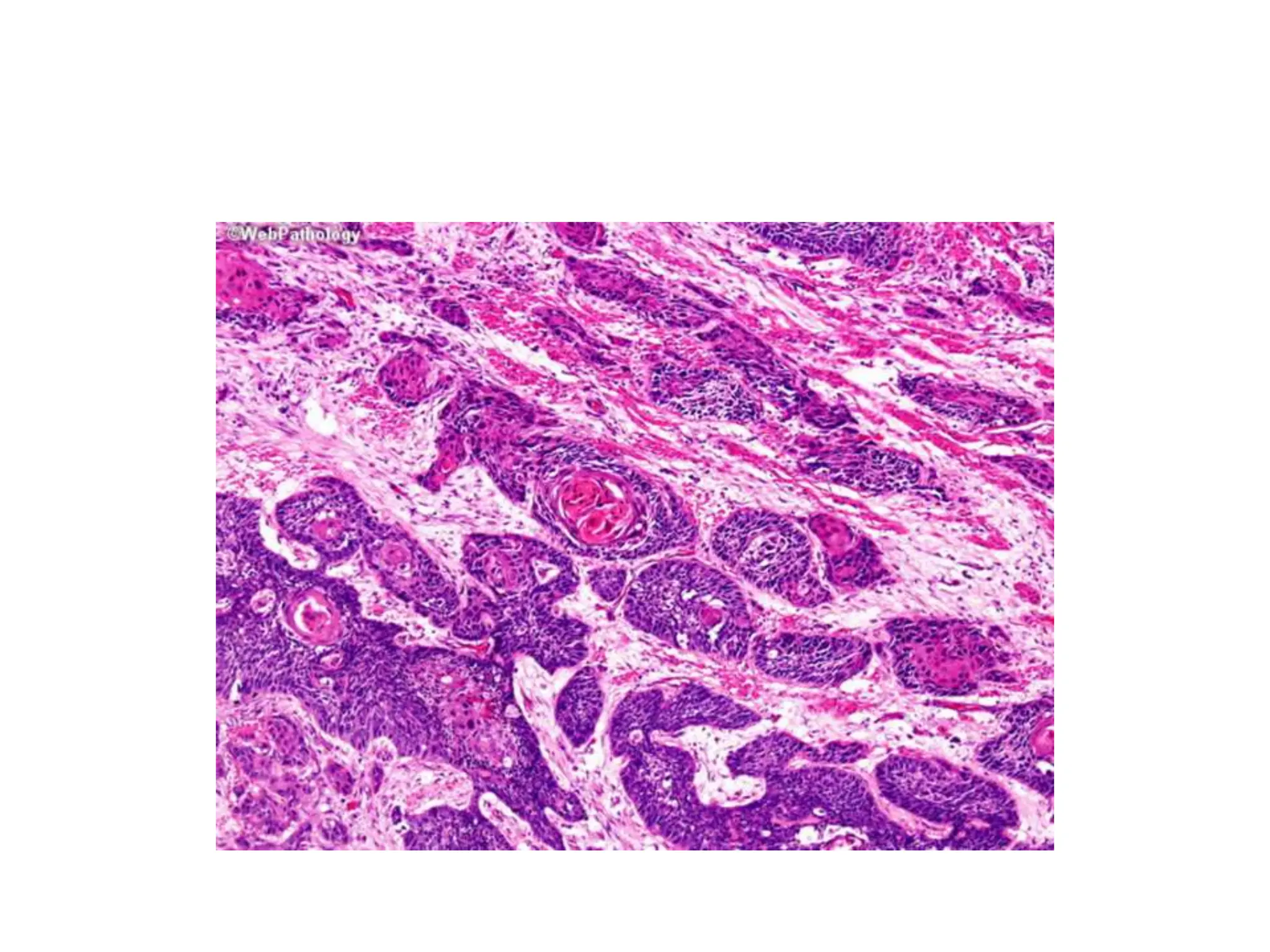 Gastrointestinal system ppt GERD Barrett's esophagus Carcinoma ...