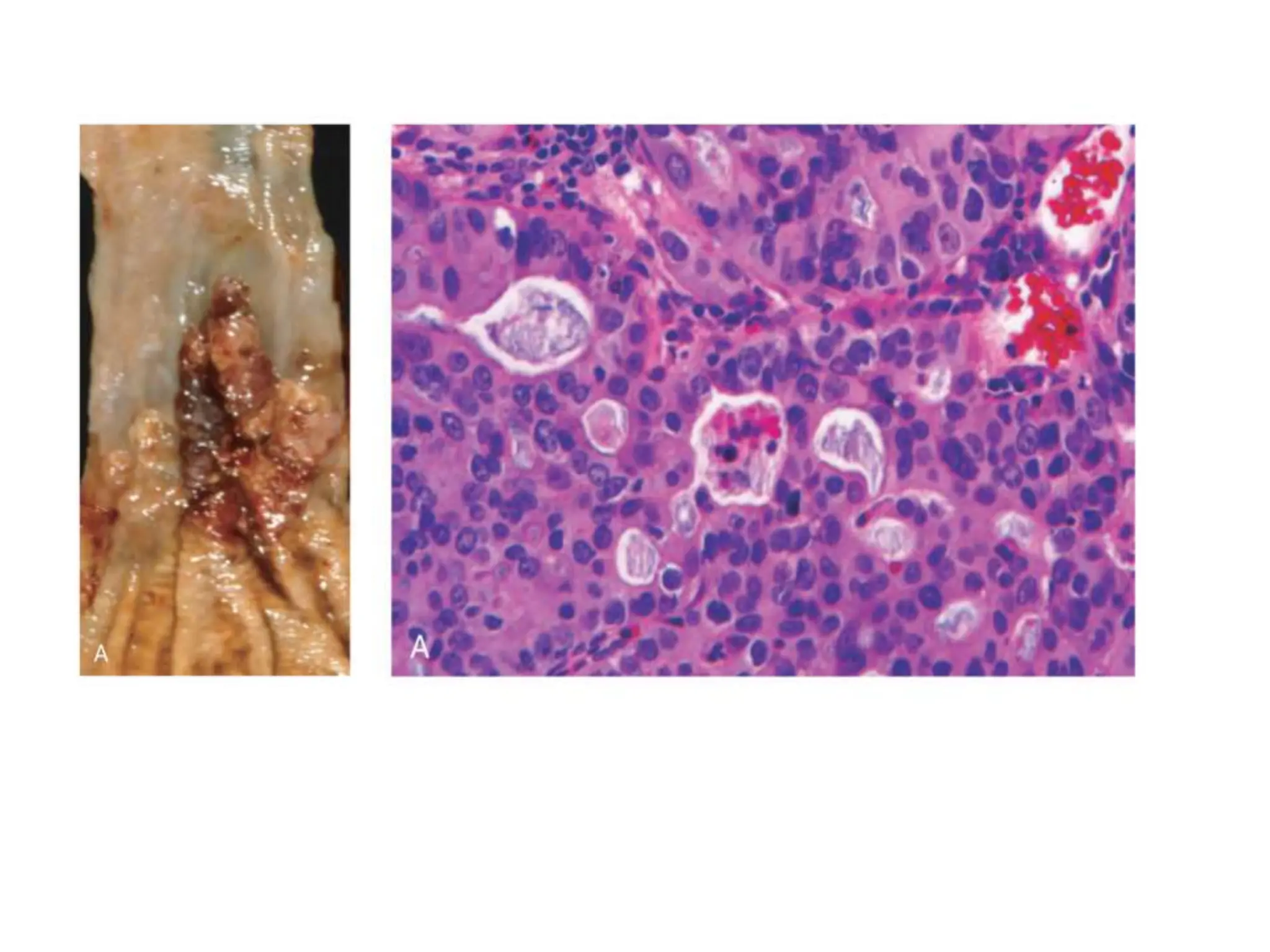 Gastrointestinal system ppt GERD Barrett's esophagus Carcinoma ...