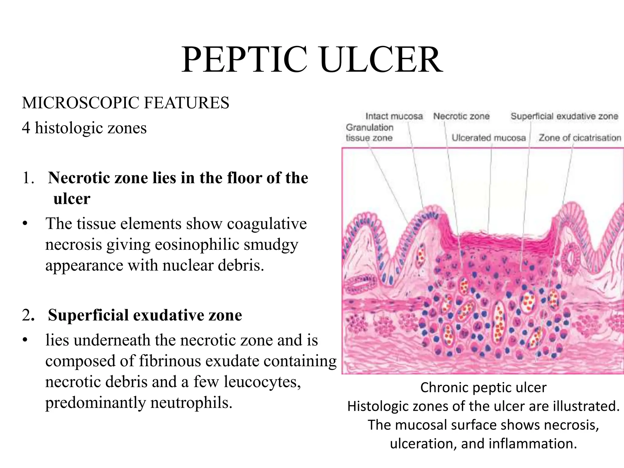 Gastrointestinal system ppt GERD Barrett's esophagus Carcinoma ...