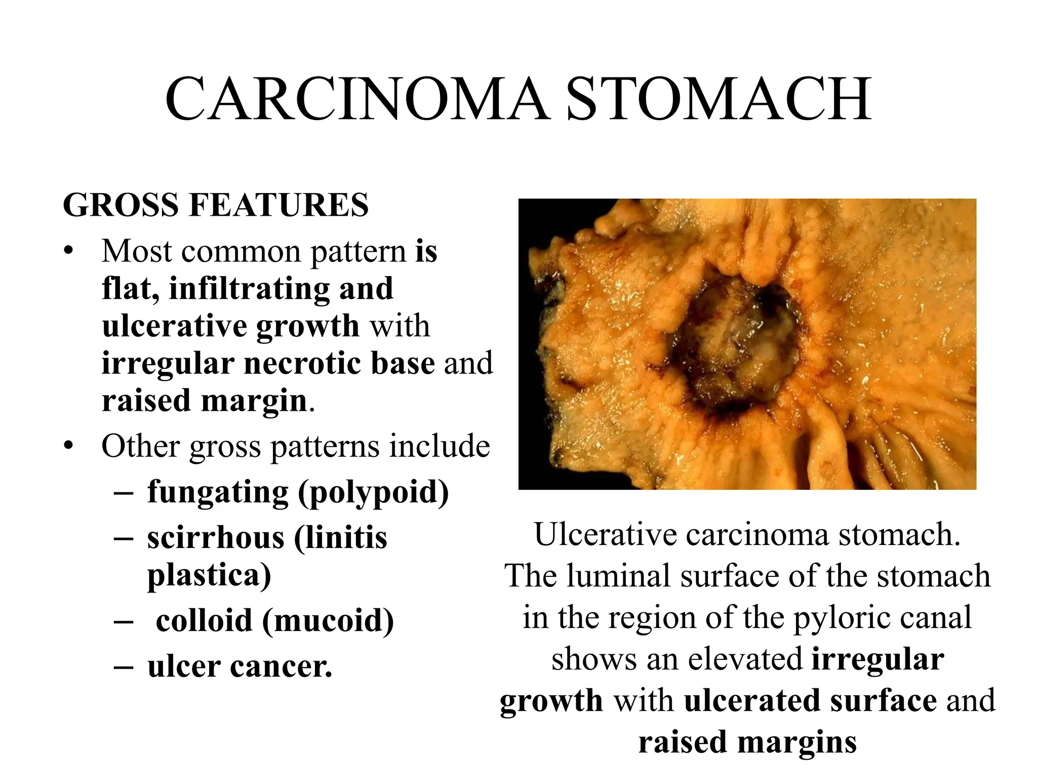 Gastrointestinal system ppt GERD Barrett's esophagus Carcinoma ...