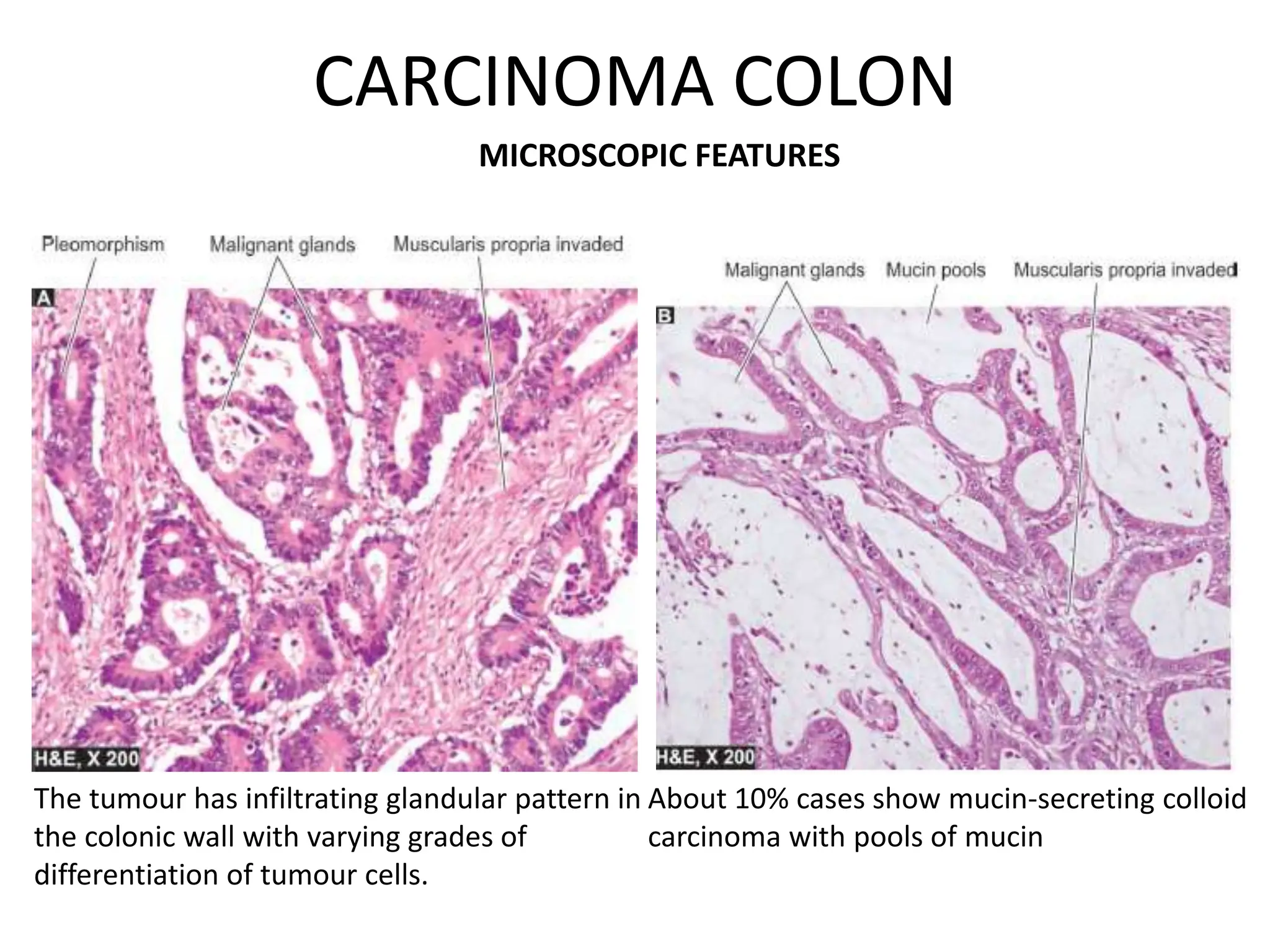 Gastrointestinal system ppt GERD Barrett's esophagus Carcinoma ...