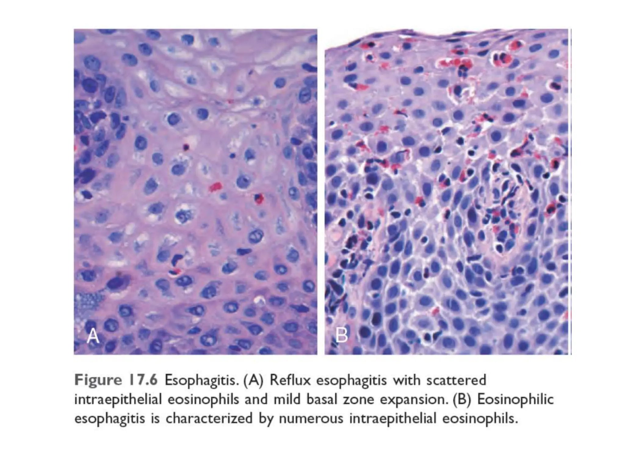 Gastrointestinal system ppt GERD Barrett's esophagus Carcinoma ...