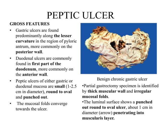 Gastrointestinal system ppt GERD Barrett's esophagus Carcinoma ...