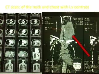 Git a very rare cause of upper gib. | PPT