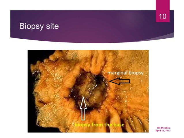 gastrointestinal tract endoscopic biopsies.ppt