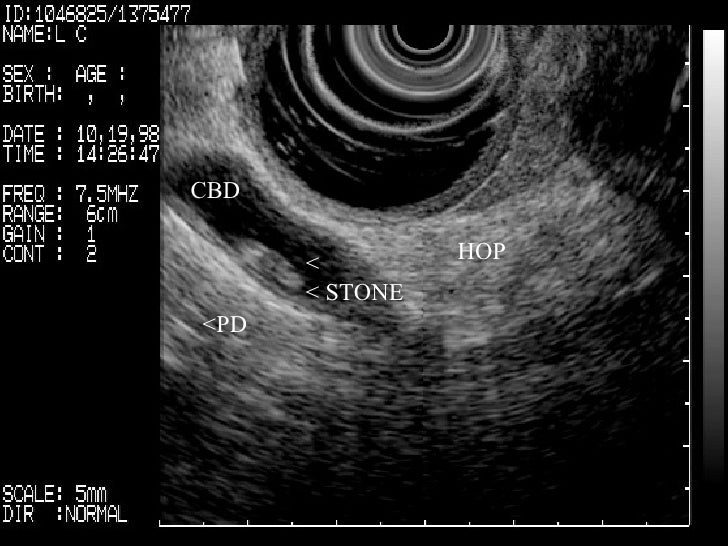 Git Endoscopic Ultrasound.