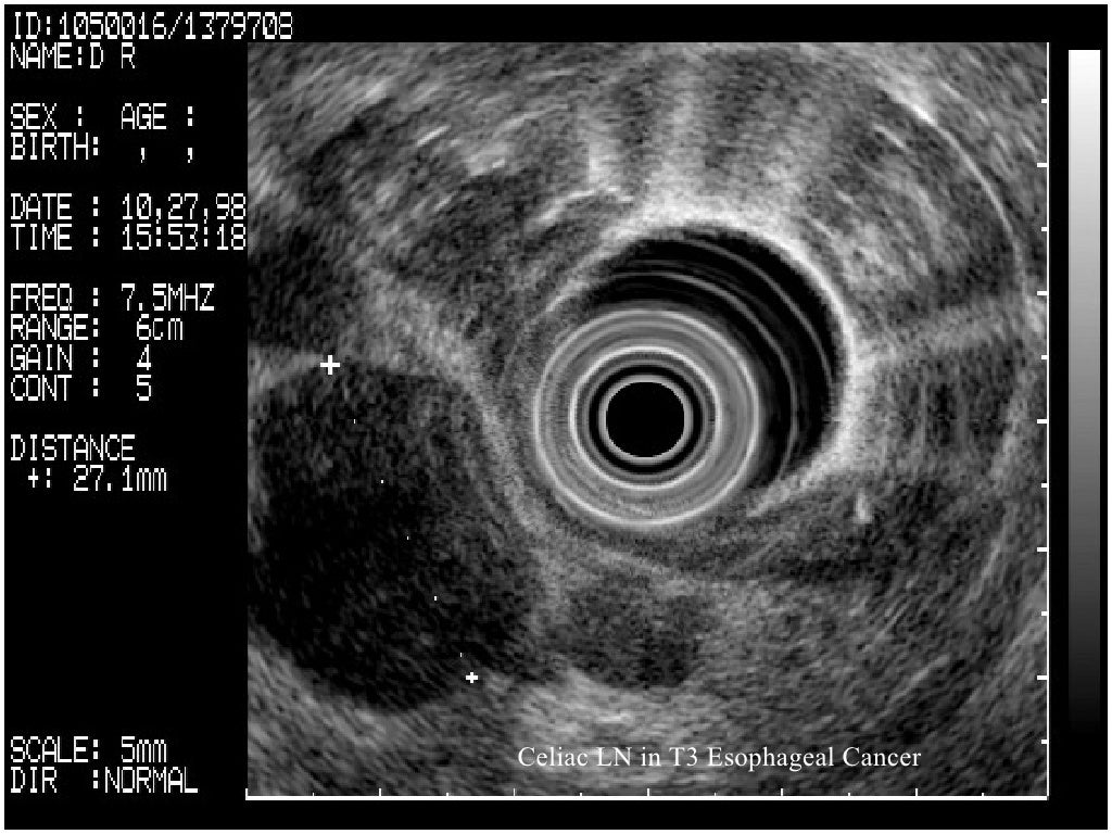 Git Endoscopic Ultrasound.