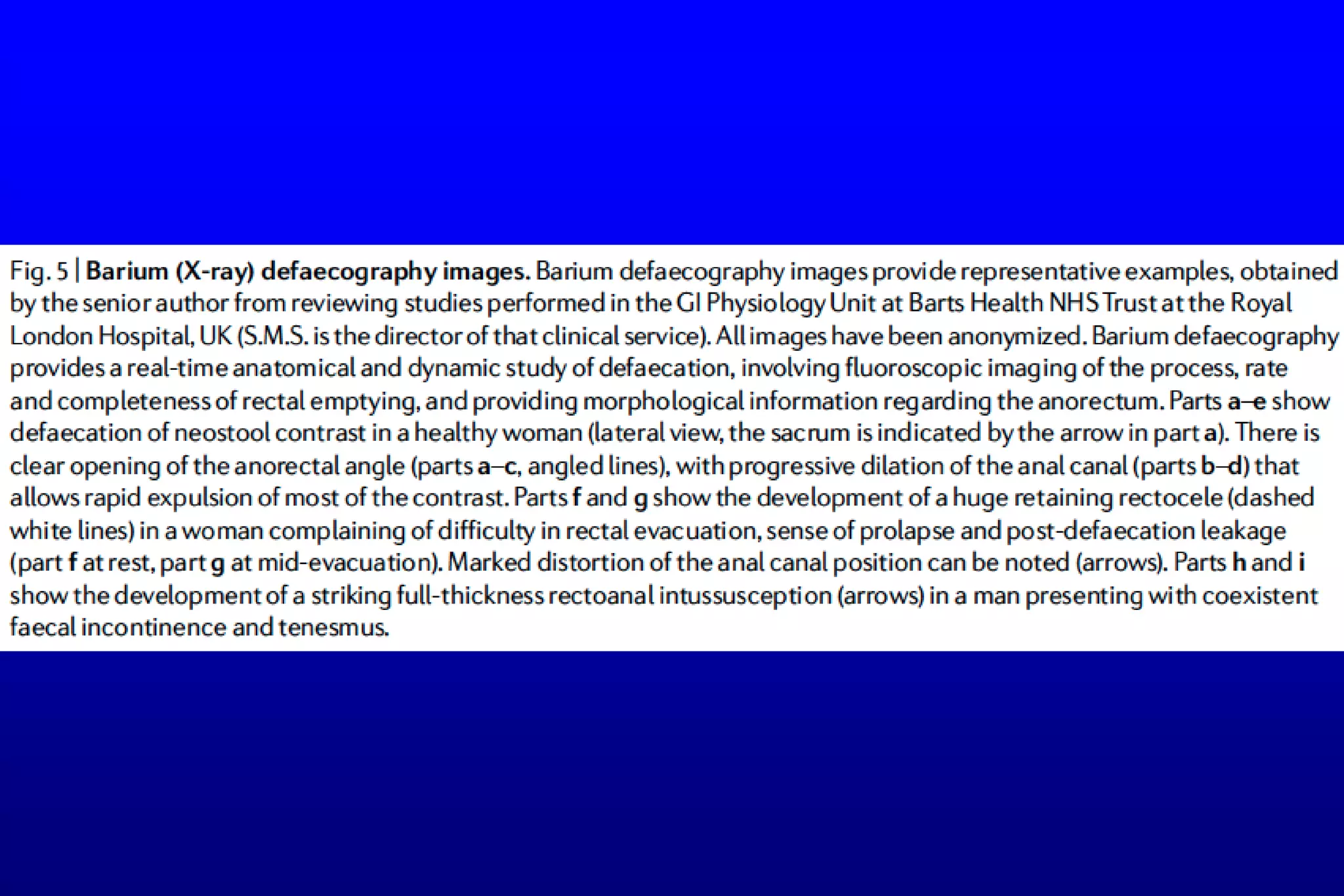 Git j club defecation physiology &disorders21 | PPT