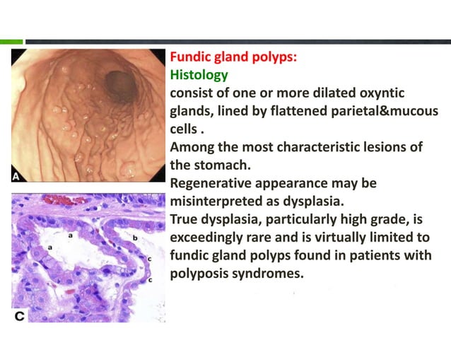 Git j club gastric polyps. | PPTX