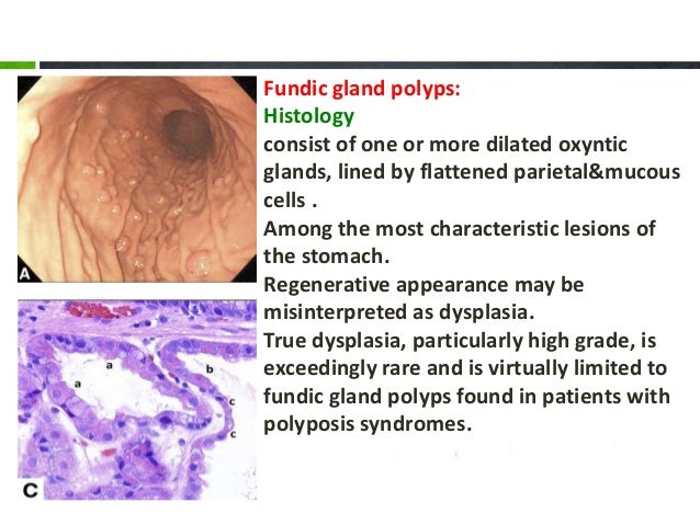 Git j club gastric polyps.