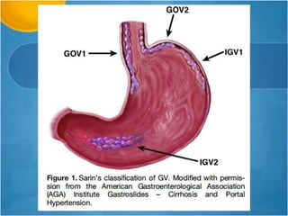 GIT Kurdistan Board GEH Journal club gastric varices.. | PPTX ...