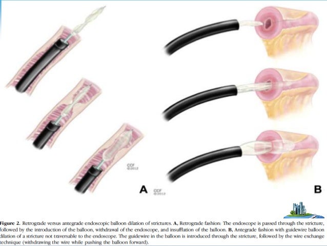 Git j club IBD endotrts.