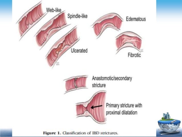 Git j club IBD endotrts.